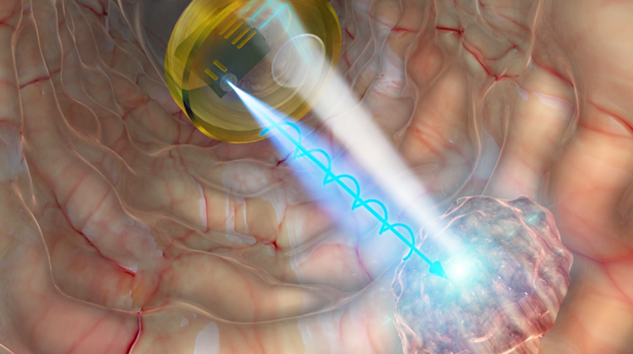 Towards the in vivo Detection of Cancer Progression Using Circularly ...