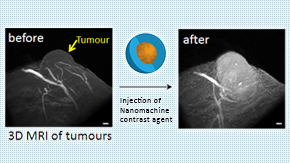 "Nanomachine Contrast Agent" using existing MRI detects minimal cancer ...